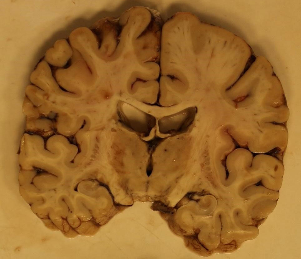 Damaged Brain Tissue