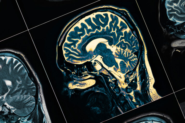 $12.5M Grant to Develop Targeted Glioma Therapies - Brigham On a Mission