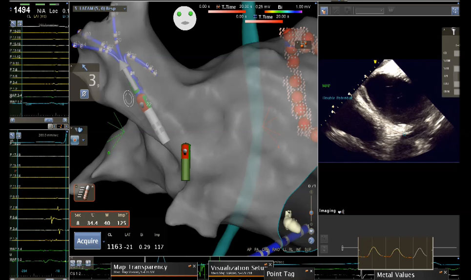 Brigham Offers Comprehensive Approach to Afib Management - Brigham On a ...